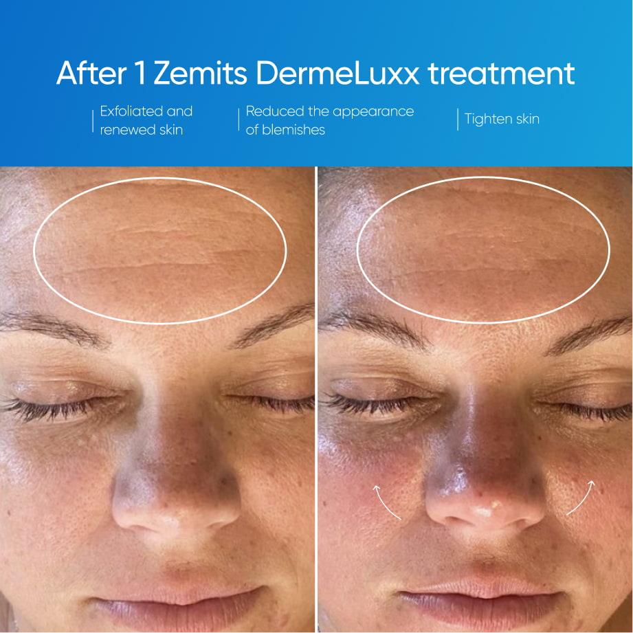 Zemits DermeLuxx Hydrodermabrasion Oxygen Cryo Facial System FOR SALE