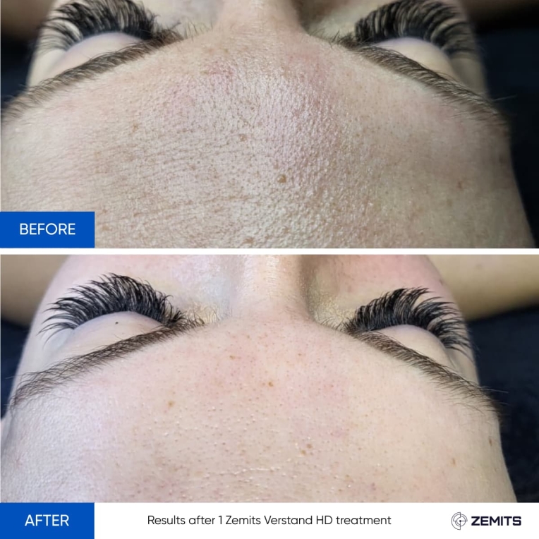 Zemits Verstand HD Full-Feature Facial System FOR SALE