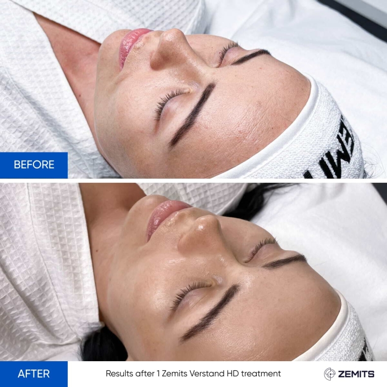 Zemits Verstand HD Full-Feature Facial System FOR SALE