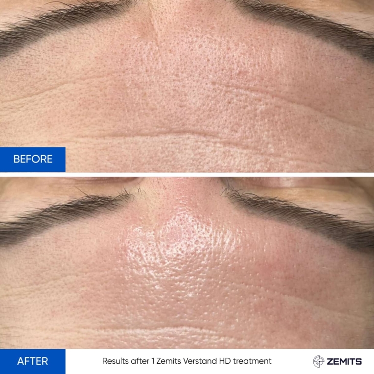 Zemits Verstand HD Full-Feature Facial System FOR SALE