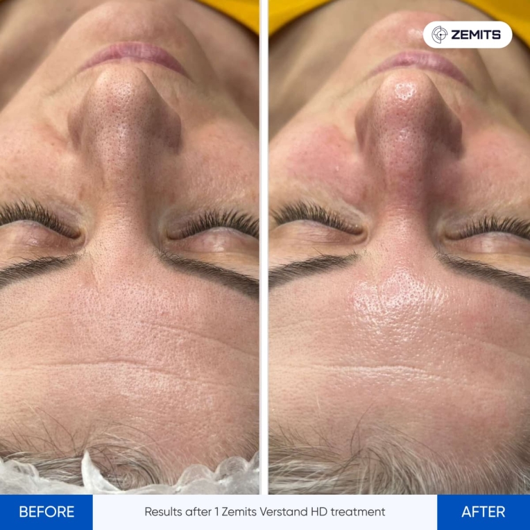 Zemits Verstand HD Full-Feature Facial System FOR SALE