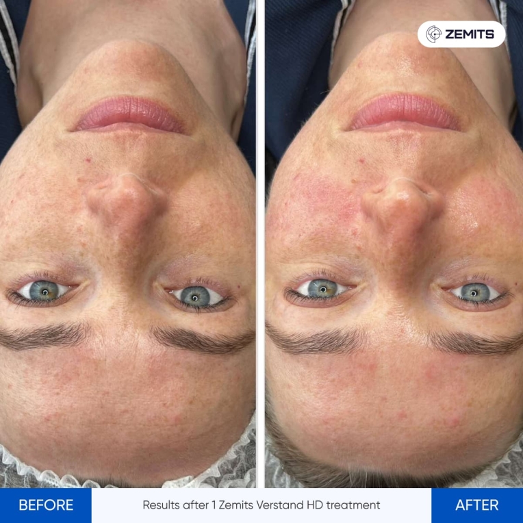 Zemits Verstand HD Full-Feature Facial System FOR SALE