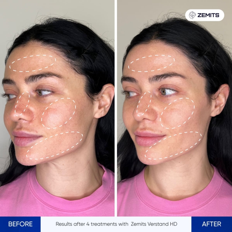 Zemits Verstand HD Full-Feature Facial System FOR SALE